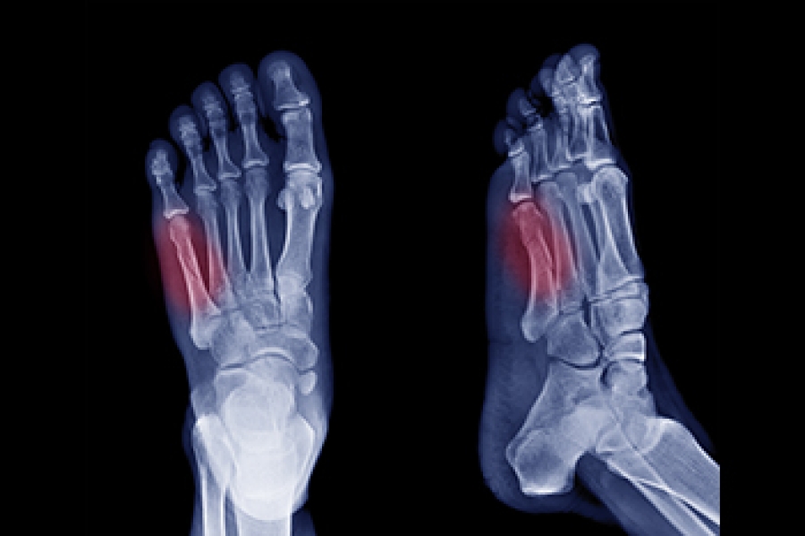 Causes of Dancer’s Foot Fracture